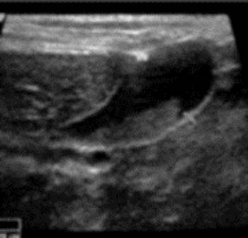 Ultrassonografia Do Ducto Biliar Comum Normal RMMG Revista Médica