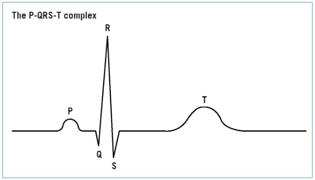 Ritmo Juncional Onda P Invertida ECG ( Eletrocardiograma)