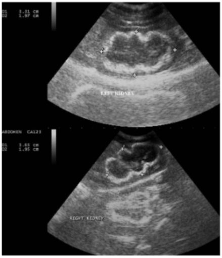 Classificacao De Hidronefrose Hidronefrose Antenatal: Causas, Sintomas